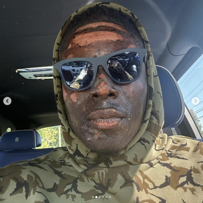 Browns TE David Njoku Reveals Shocking Facial Burns He Suffered In Fire ...