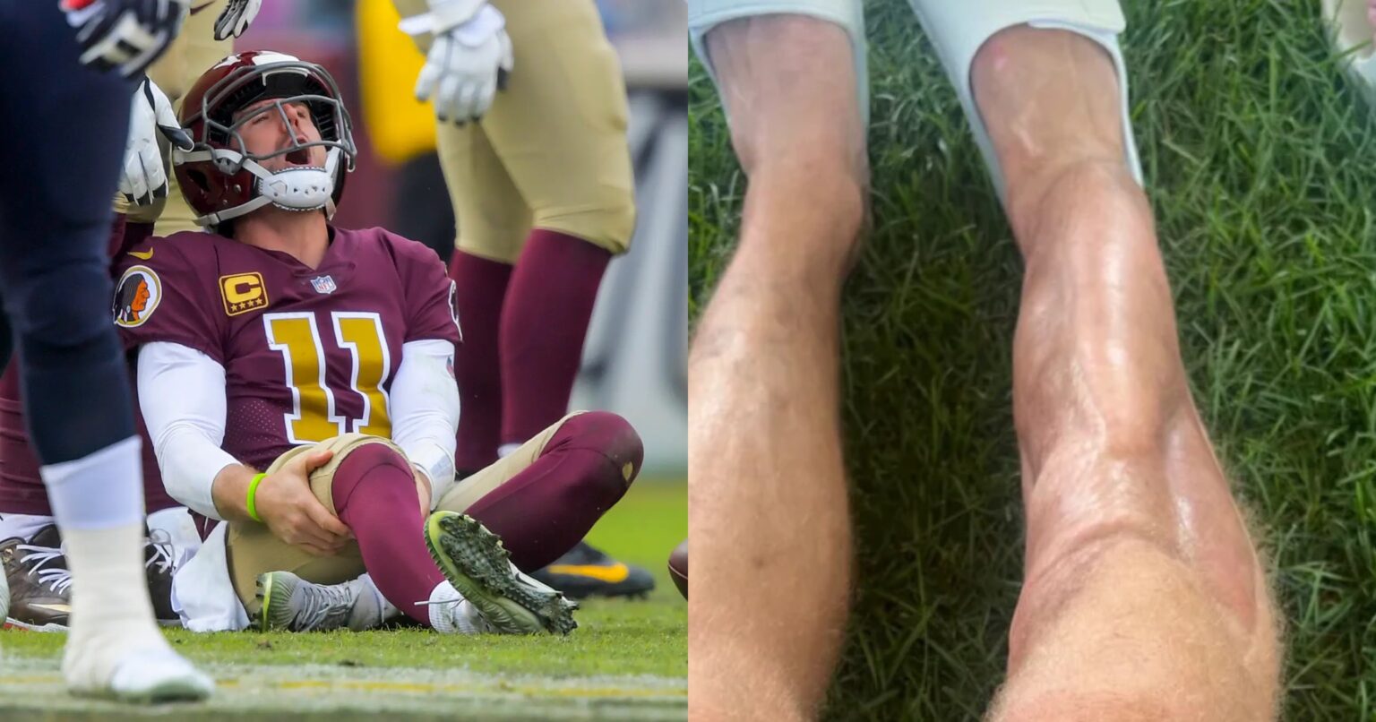 Alex Smith Shares Gruesome Photo Of His Surgically Repaired Leg Six ...